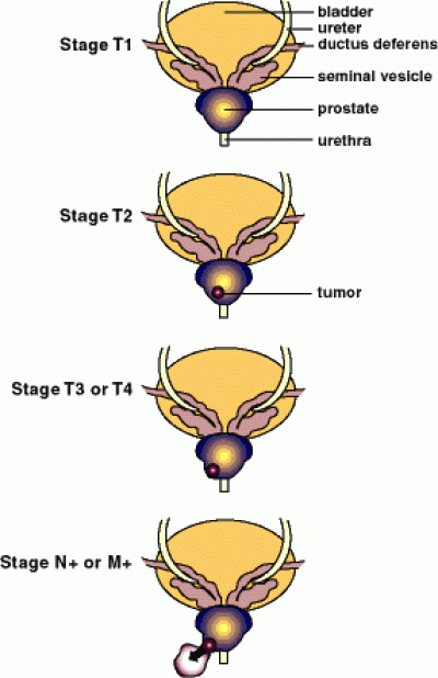 Cancer Stages